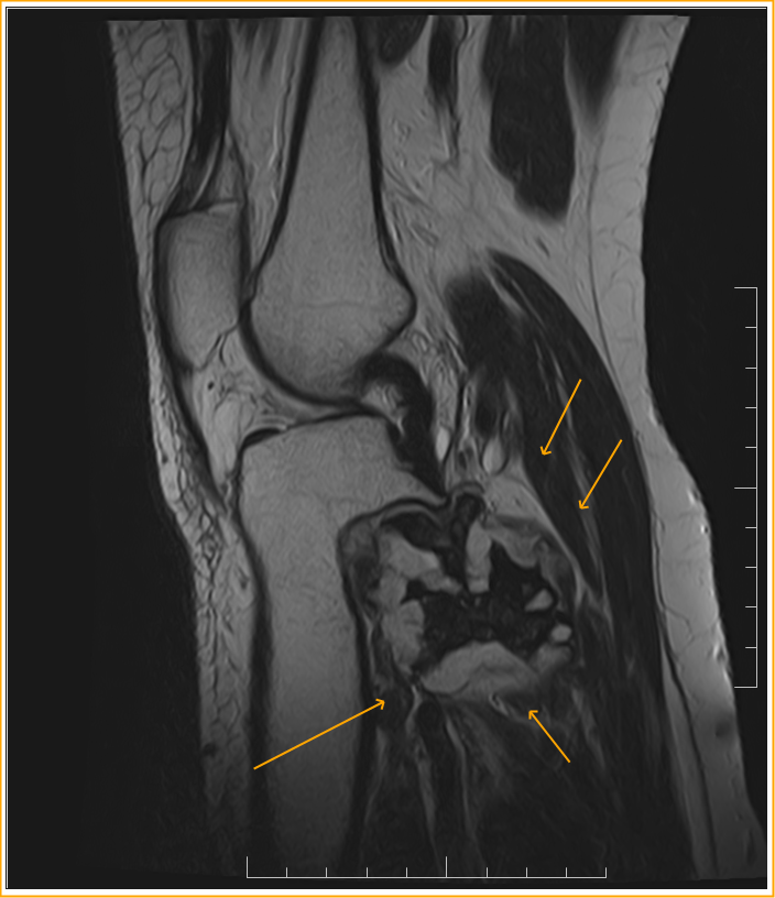 Fibular Osteochondroma-MRI - Sumer's Radiology Blog