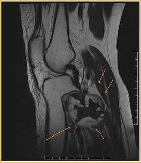Fibular Osteochondroma-MRI - Sumer's Radiology Blog