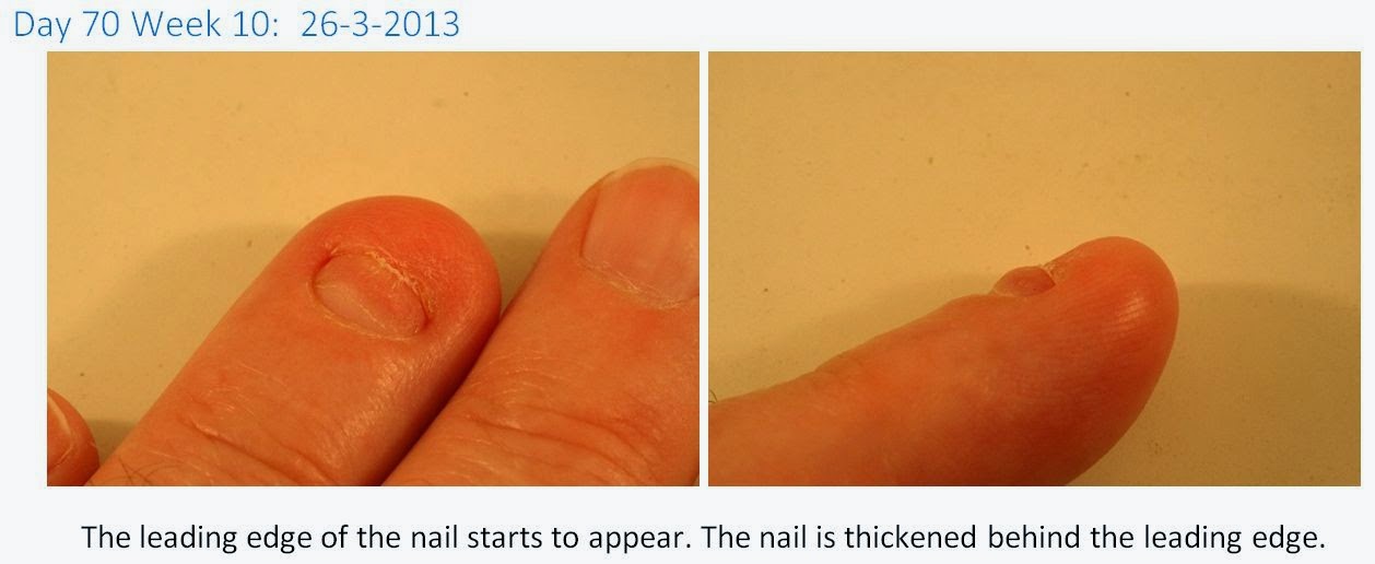 Personal Touch Works: Recovery from a ripped off finger nail