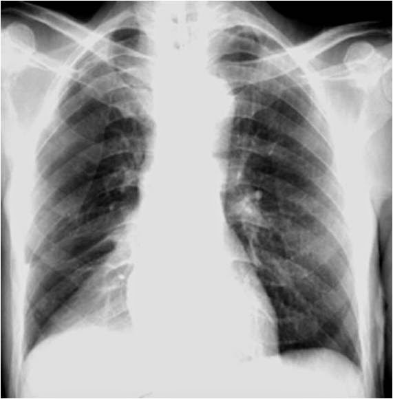 RADIOLOGY IMAGE SPOTTERS: Right lower lobe collapse