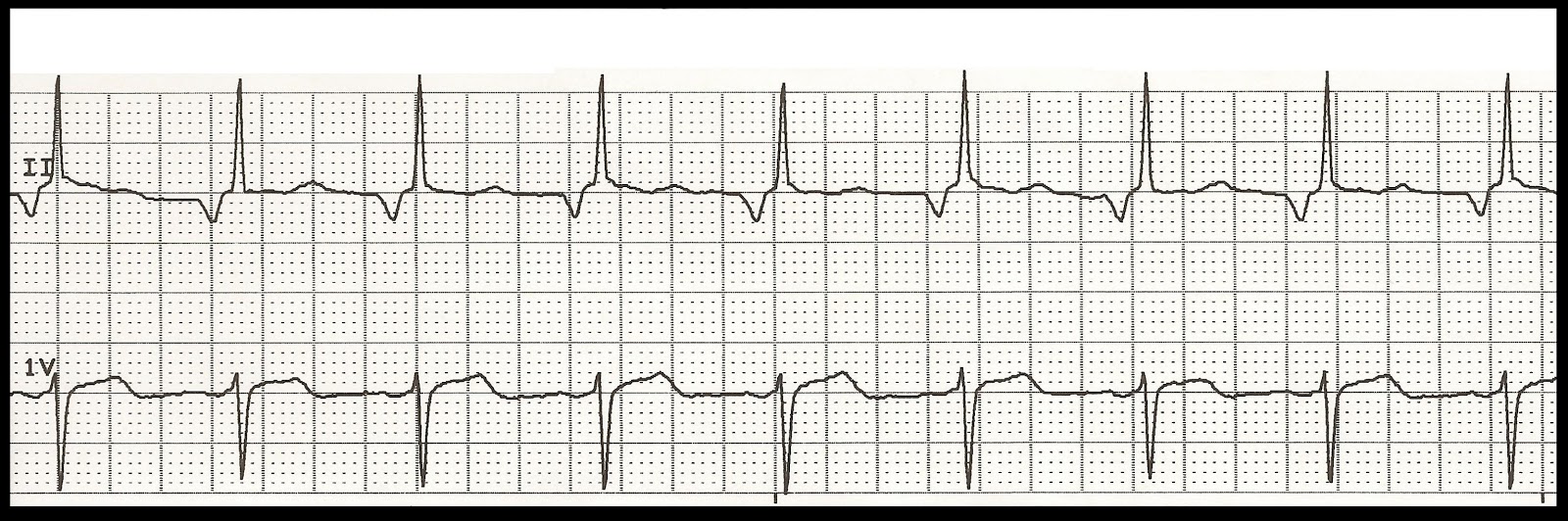 Float Nurse: EKG Rhythm Strip Quiz 98: Junctional rhythms