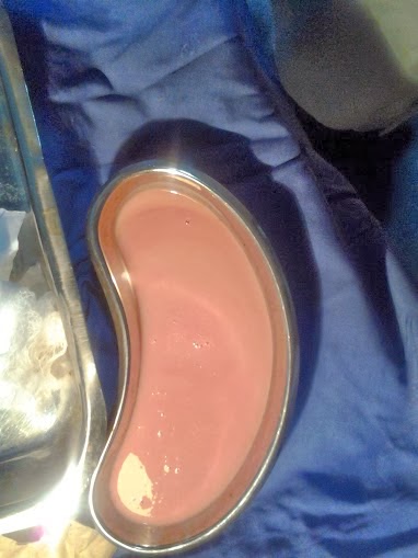 AMOEBIC LIVER ABSCESS