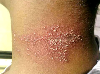 Flonimal Nesia: Mewaspadai Serangan Tomcat Yang Mewabah Kembali