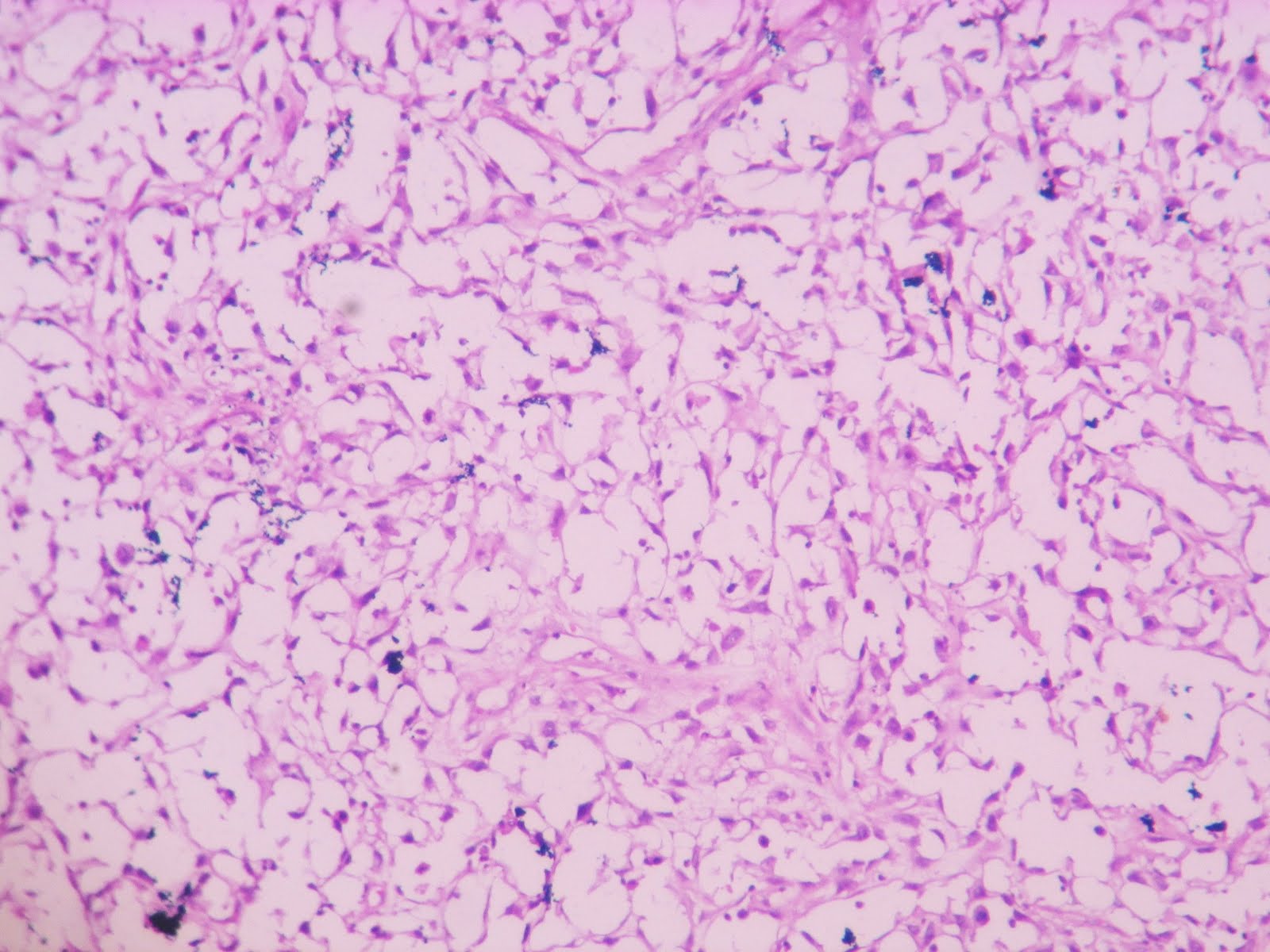 into the roots: Sarcomatoid variant of transitional cell carcinoma