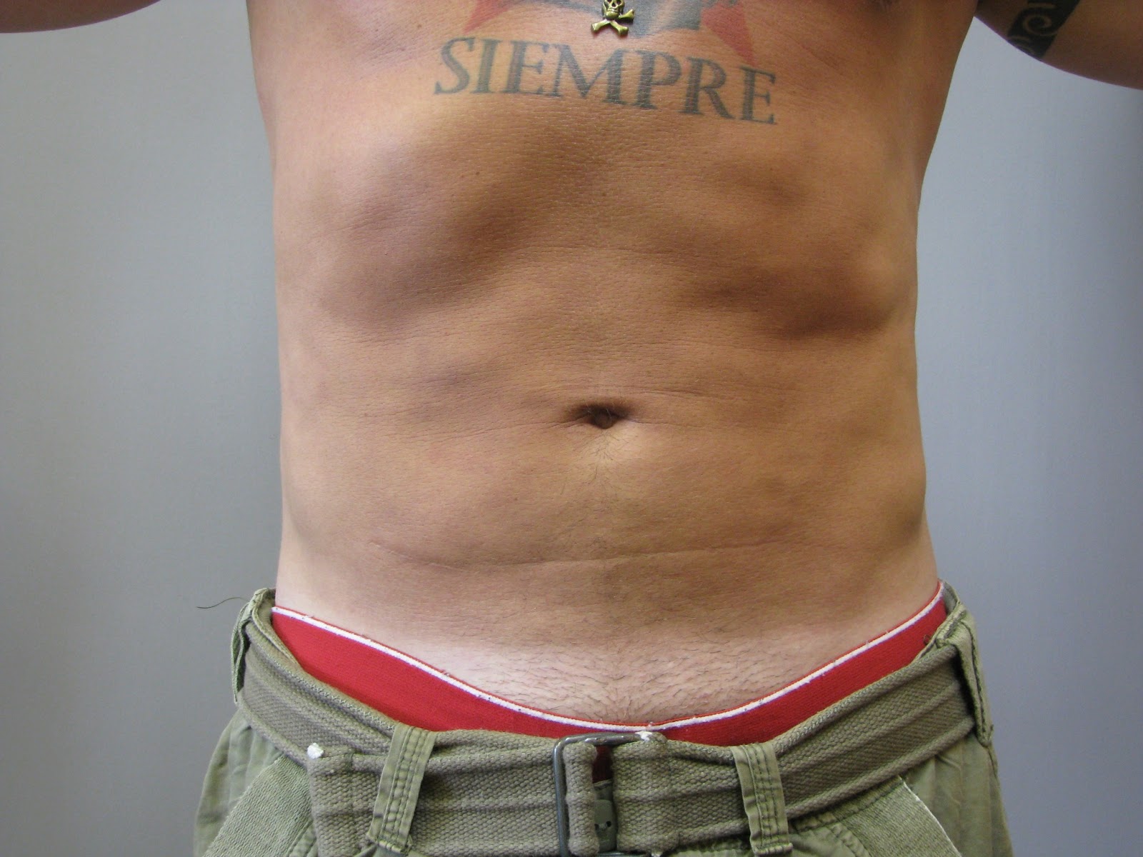 Selston Cosmetic Clinic: Vaser Lipo Abs..Before and After