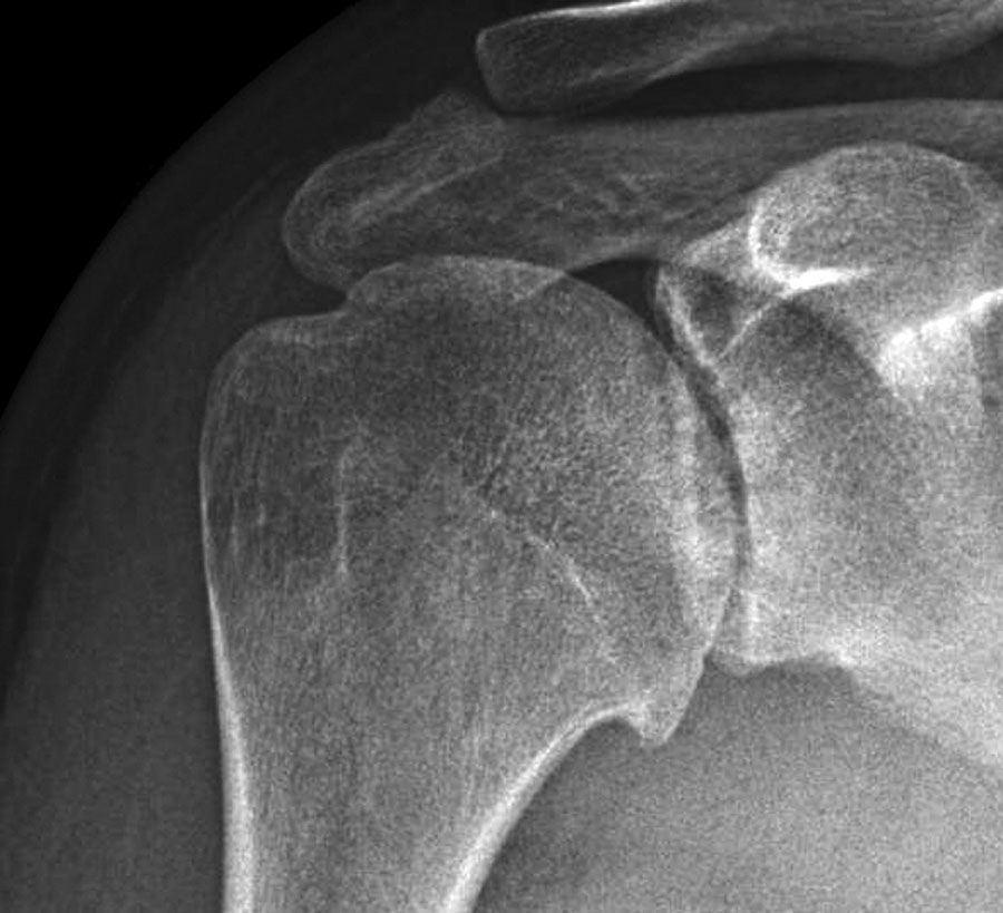 UW Shoulder and Elbow Academy: Chondrolysis of the shoulder, x-ray ...