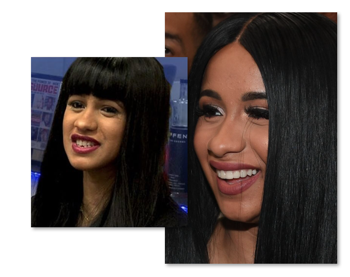 Cardi B Teeth Before And After Old Smile Vs New