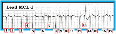 ECG Interpretation: ECG Blog #71 (PVC – AFib – Ashman – Aberrancy)