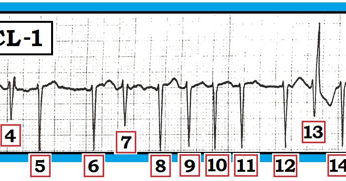 ECG Interpretation: ECG Interpretation Review #71 (PVC – Aberrant ...