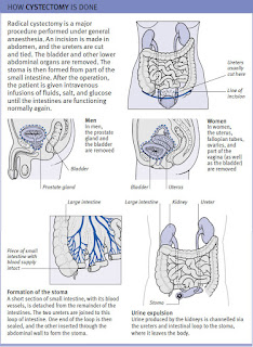 cystectomy ~ Nursing