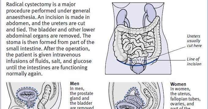 cystectomy ~ Nursing