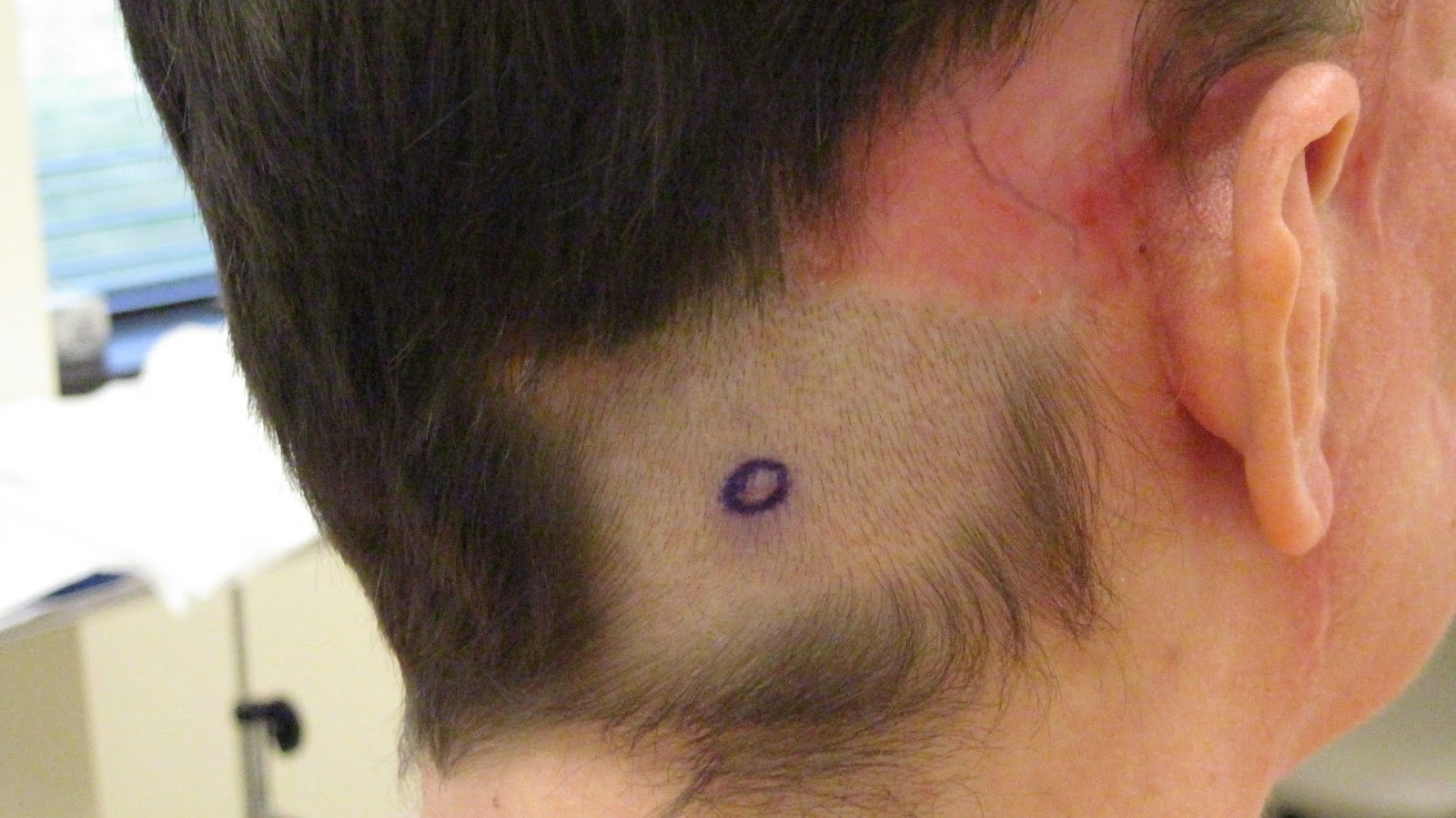 Basal Cell Nevus Syndrome-My Journey: Mile 21 with Basal Cell Nevus ...