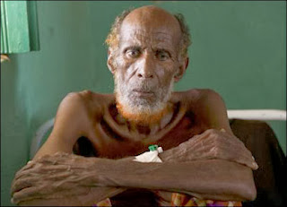 Envelhecimento: Desnutrição