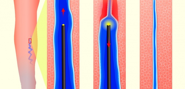 Varisli Damarlardan Kurtulmak İçin Evde Uygulanabilecek 8 Yöntem ...