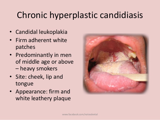 Anchor2Health: How to Confirm a Yeast Infection