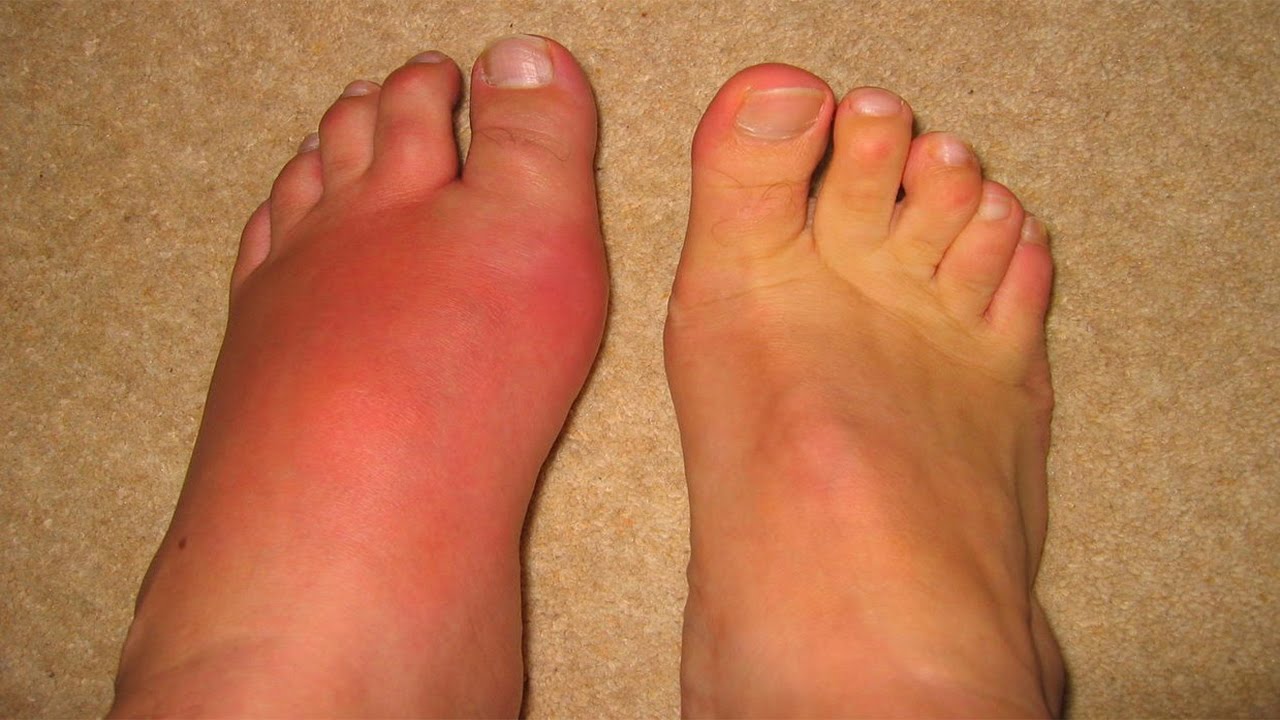 Gout gout