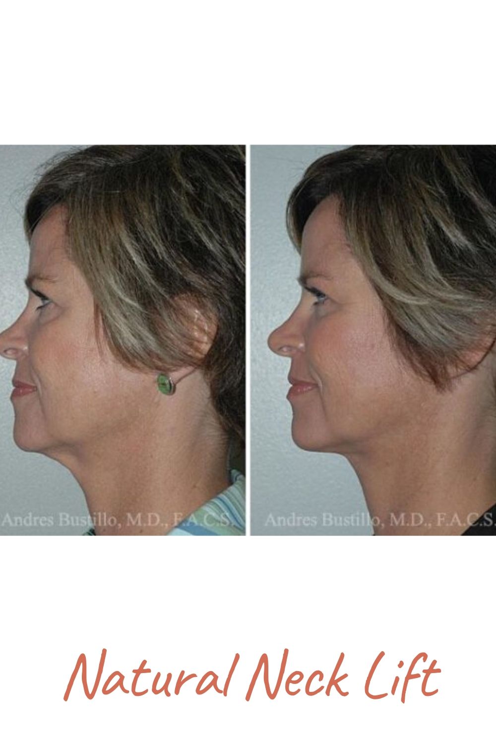 Natural Neck Lift - Pukrol Satwa