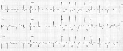 Dr. Smith's ECG Blog: Young Woman with history of repaired Tetralogy of ...