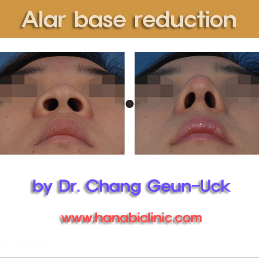 Best nose job clinic in Korea: Hanabi's alar base reduction