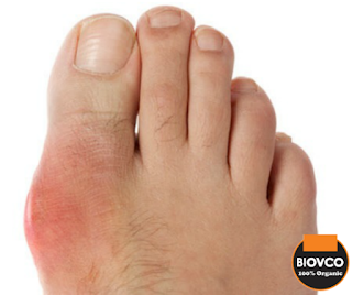 Apa sebenarnya penyakit gout? – Info Kesihatan