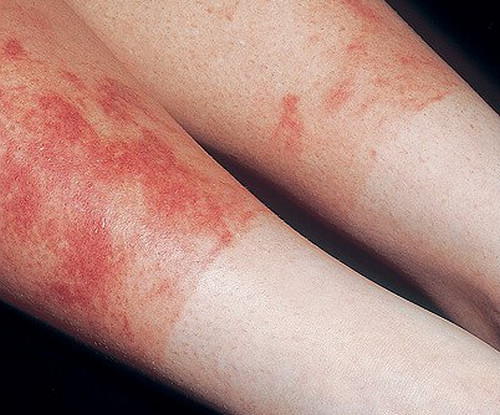 Sun Rash Pictures | Medical Pictures and Images - (2023 Updated)