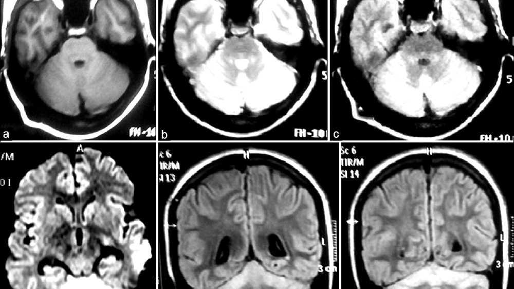 Post viral cerebellar ataxia