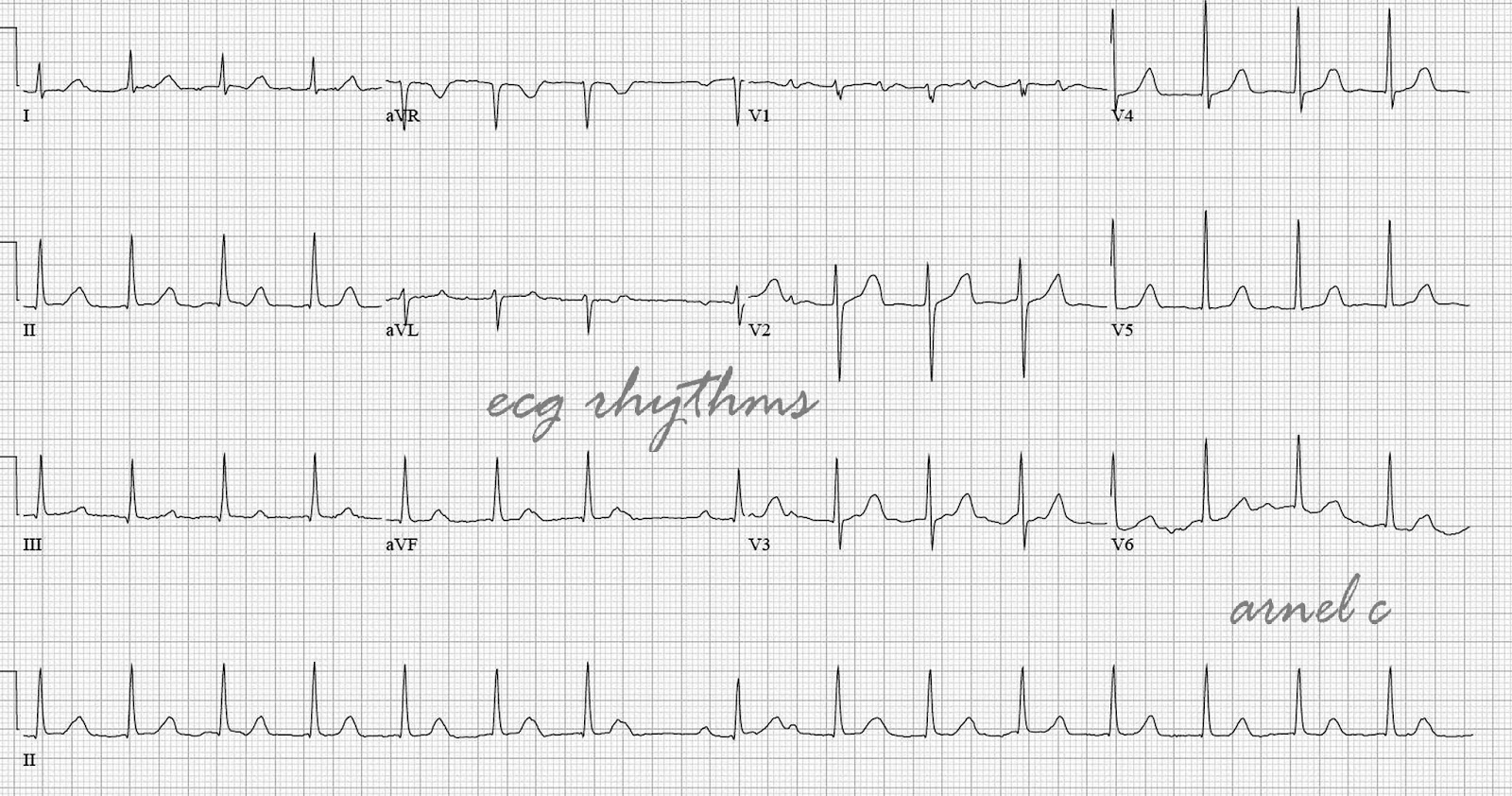 ECG Rhythms: Atypical Wenckebach