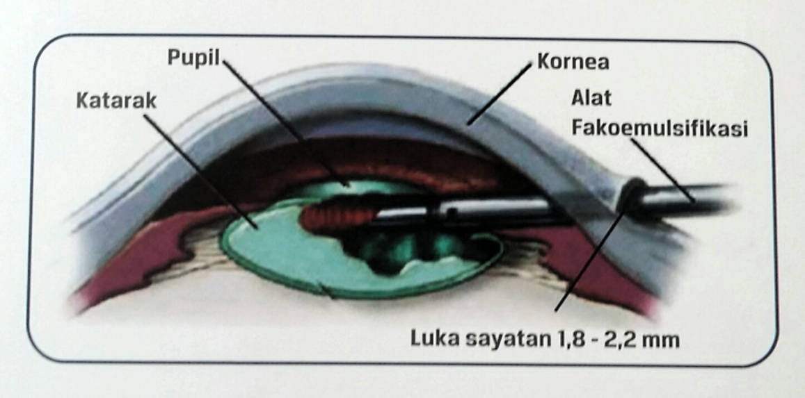Informasi Tentang Katarak & Bladeless laser katarak