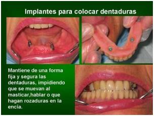 APARATO DE ODONTOLOGIA: IMPLANTES ENV PROSTODONCIA TOTAL