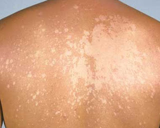 ASK DIS: Treatment of Tinea Versicolor