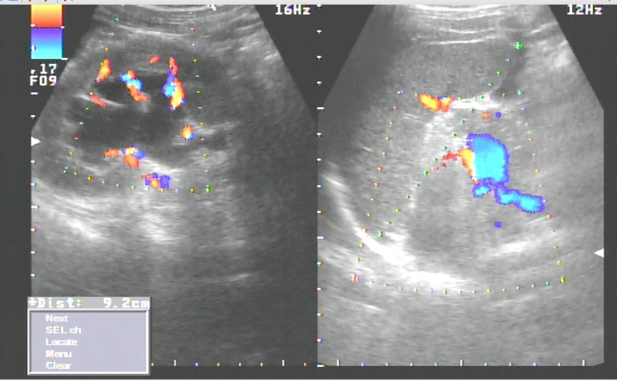 VIETNAMESE MEDIC ULTRASOUND: CASE 532: URINOMA and A 2-Year Tap Wound ...