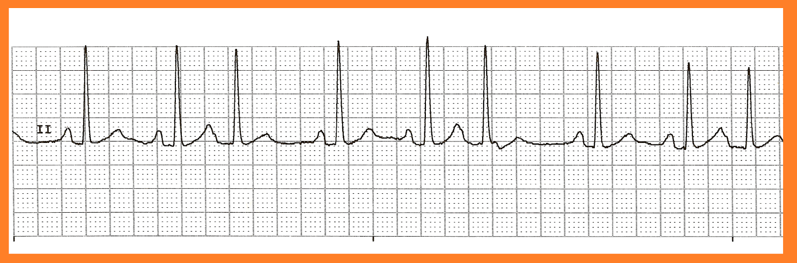 EKG Rhythm Quiz 254