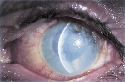 Deformutilation: Corneal Chemical Burns