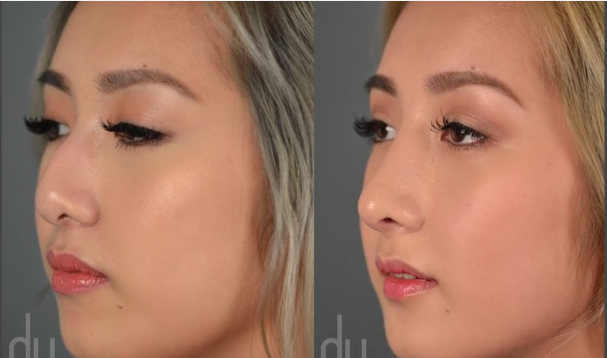 Asian Rhinoplasty Procedure | Korean Nose Job Experience | Kpop Plastic ...