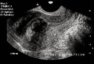 Miomatosis Uterina: Síntomas de los miomas