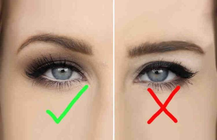 TREATING SAGGING EYEBROWS(EYEBROW LIFT) WITHOUT SURGERYWITH THREADS)