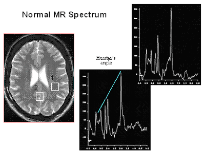 MRI Protocols: BASIC PHYSICAL PRINCIPLES OF MR SPECTROSCOPY