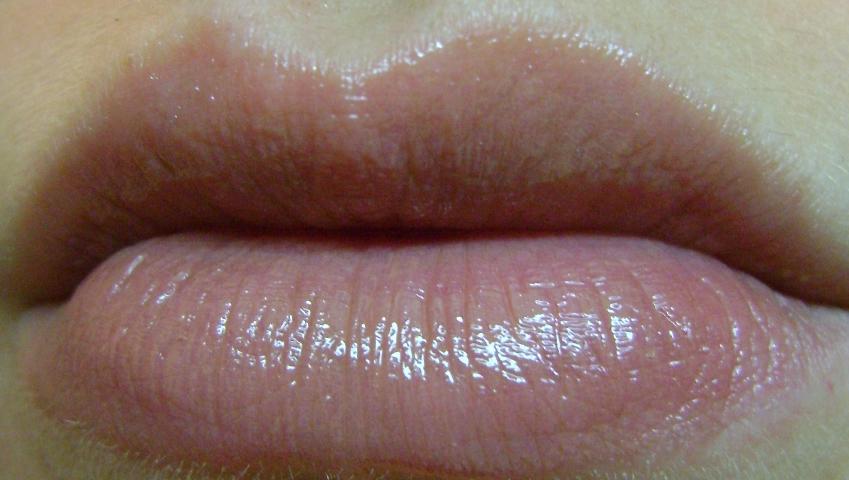 Labioplastia reduz o volume da boca | Toda Comunicação