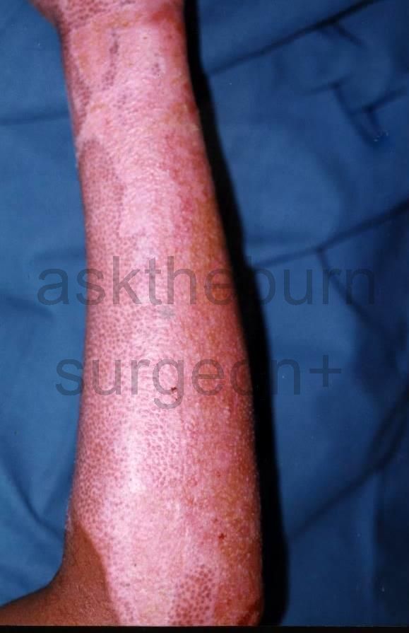 Ask The Burn Surgeon +For Free+: BURN PICTURES AND BURN VIDEOS.