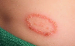 Top 6 Natural Treatment and Remedies for Ringworm - Healthcare Gyan ...