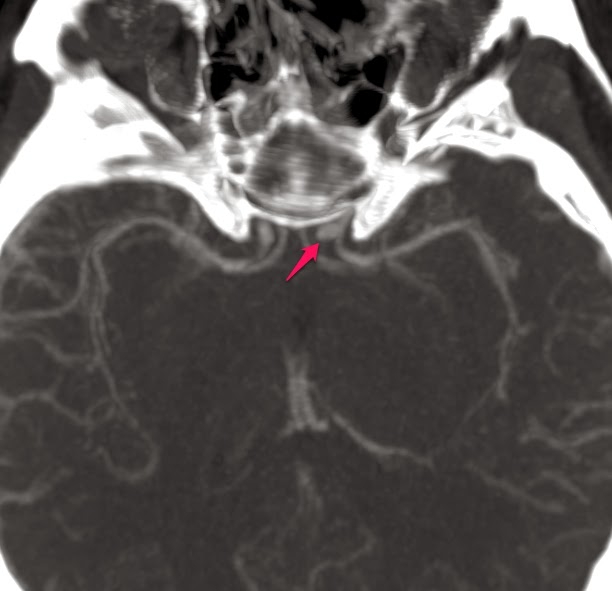 BLOG SCAN - RA Radiologistas Associados: HEMORRAGIA SUBARACNOIDE
