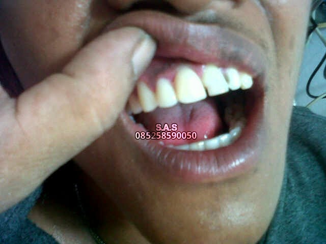 S.A.S - AHLI GIGI KOTA PATI, Jateng & KOTA JEMBER, Jatim: Foto Contoh ...