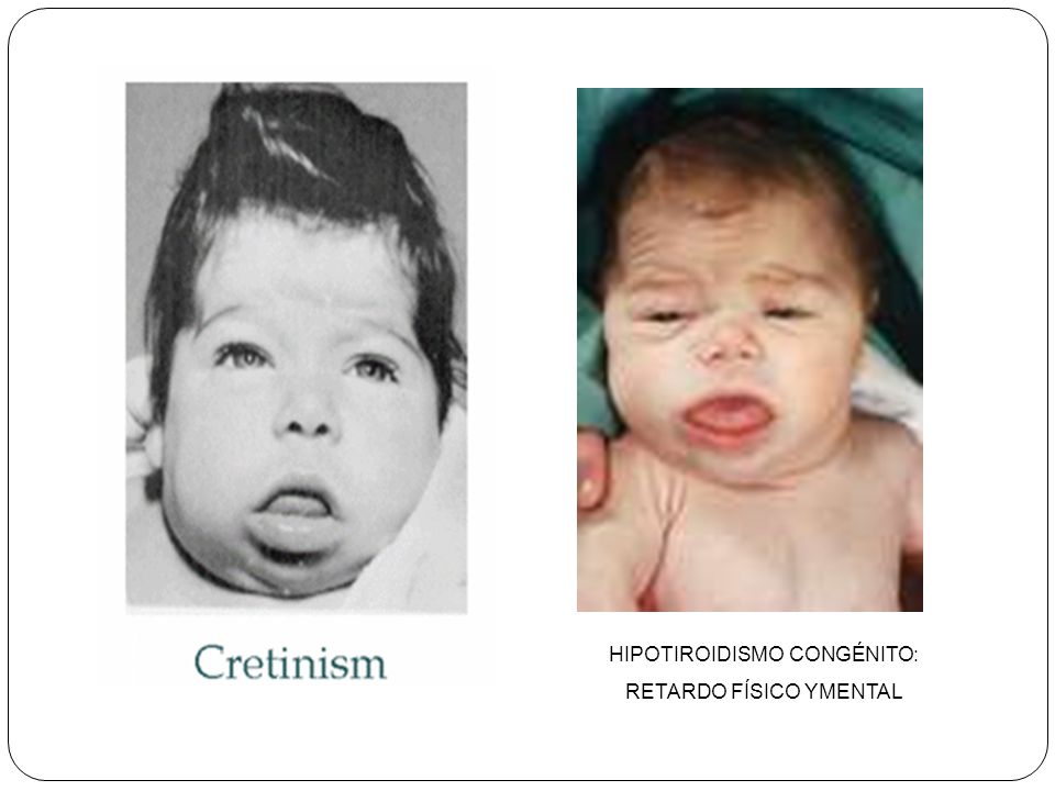 HIPOTIROIDISMO - ADULTOS: Hipotiroidismo congénito (HC)