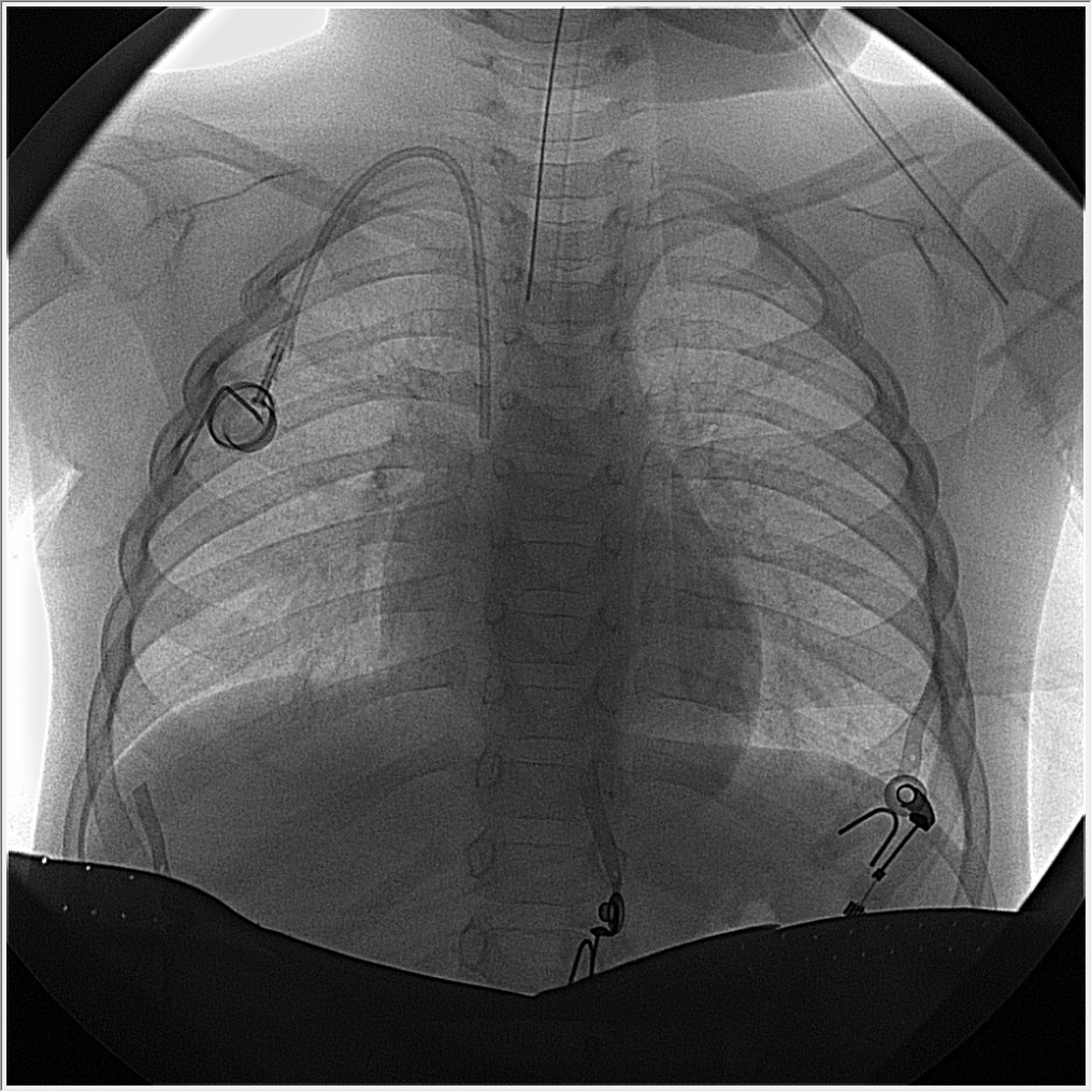 El somriure savi: Posem el port a cath.