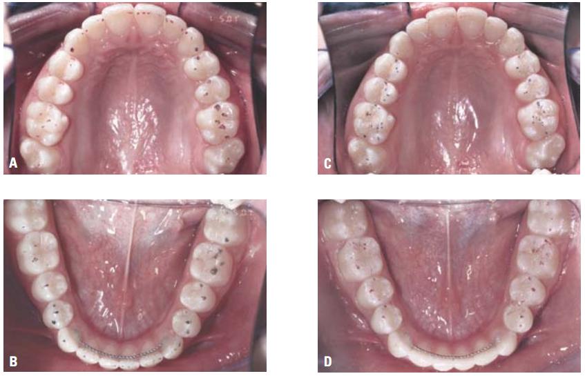 Bueno Ortodontia: Ajuste oclusal na Ortodontia: por que, quando e como?