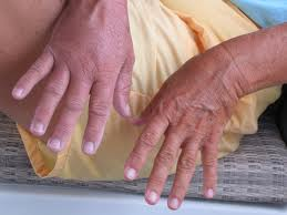 Diabetes Hand Pain Swollen