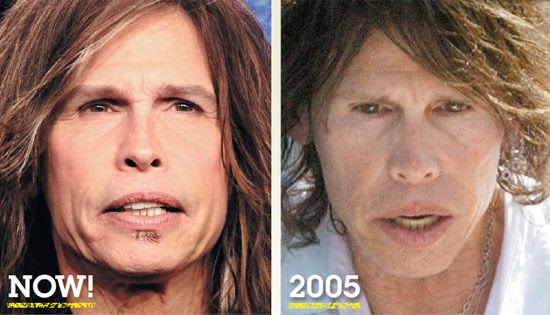 Steven Tyler Before After American Idol Plastic Surgery?New Celebrity