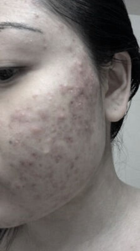 Cushing's Disease: Cushing's Frequently Asked Questions (FAQs)