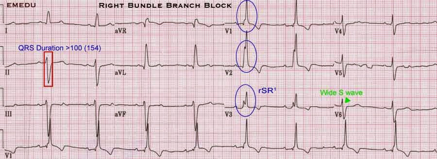 Right Bundle Branch Block INA ECG Right Bundle Branch Block INA ECG