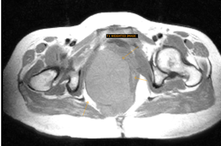 Perirectal Cyst-Differentials - Sumer's Radiology Blog